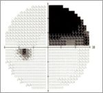 visual fields quadantanopia
