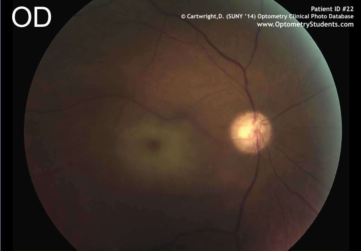 Clinical Case Review: Complete Vision Loss OD Following a "Stroke ...